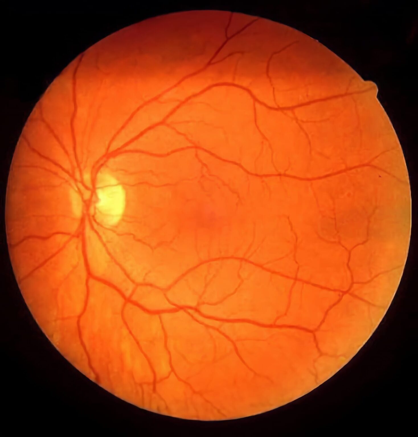 Mapeamento de Retina – Oftalmologia Largo do Machado